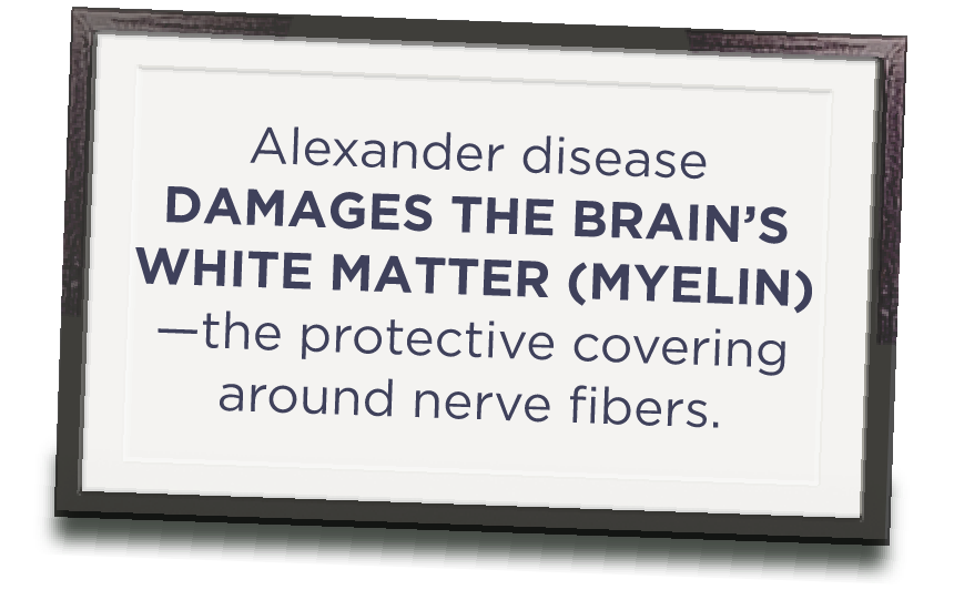 Alexander Disease: Symptoms, Causes, Diagnosis | IONIS